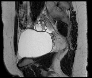 Imagerie utérus et ovaires - radiologie de la femme