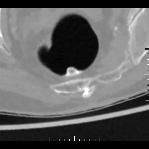 Coloscopie virtuelle : outil de dépistage cancer colorectal l ...